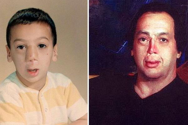 El niño desfigurado, una historia de vida con final ¿feliz? - Howard ...