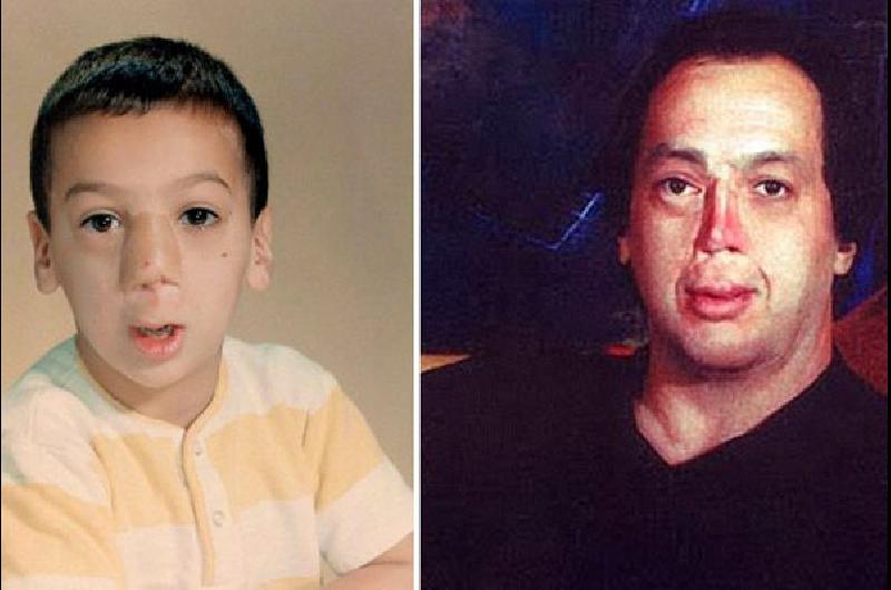 El niño desfigurado, una historia de vida con final ¿feliz? - Howard ...