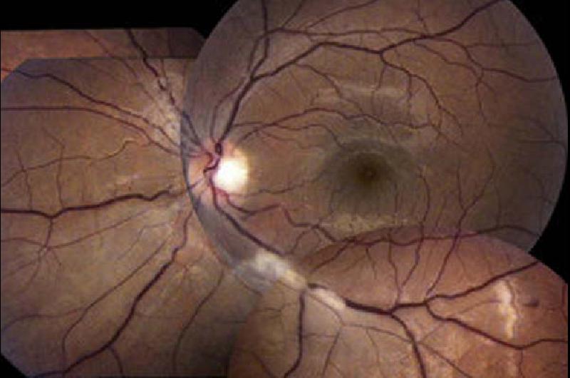 ¿Qué es la oclusión de rama venosa de la retina? - Las arterias y las ...