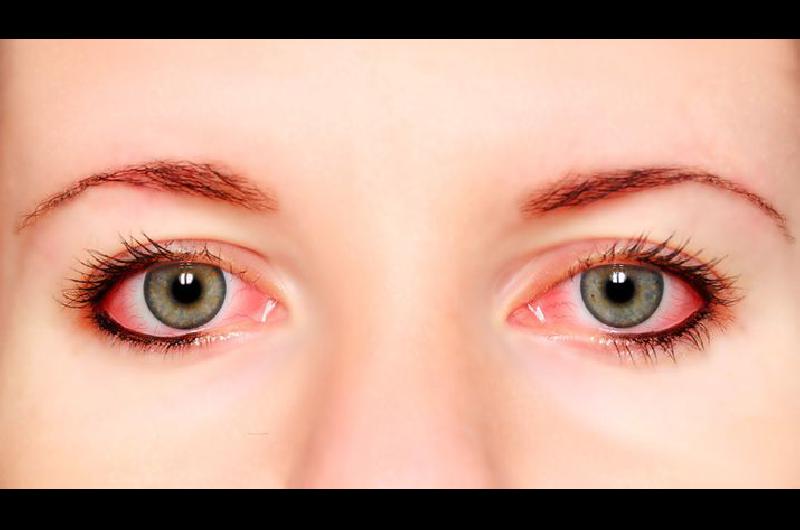 Qué hay detrás de los ojos rojos - Por el Dr. Ricardo Passone ...