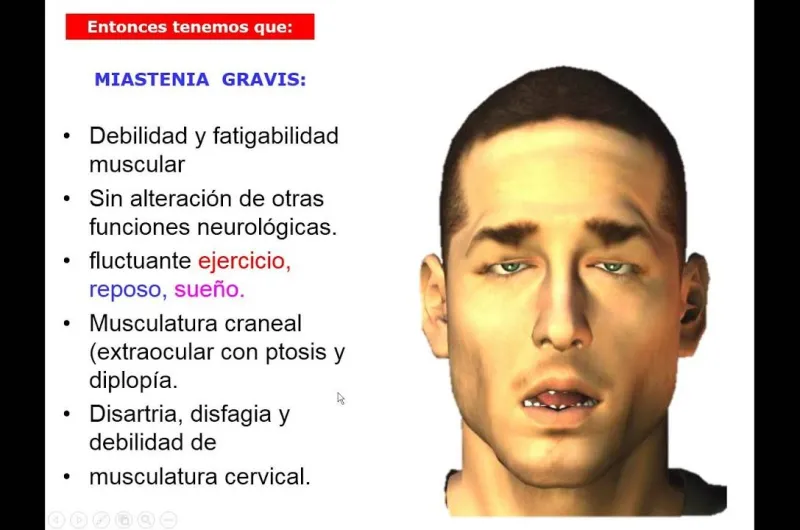 Miastenia Gravis: afección poco frecuente con varios casos en Santiago ...