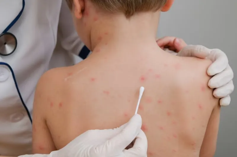 Sarampión en Argentina: cómo se explica su reaparición y qué respuestas ...